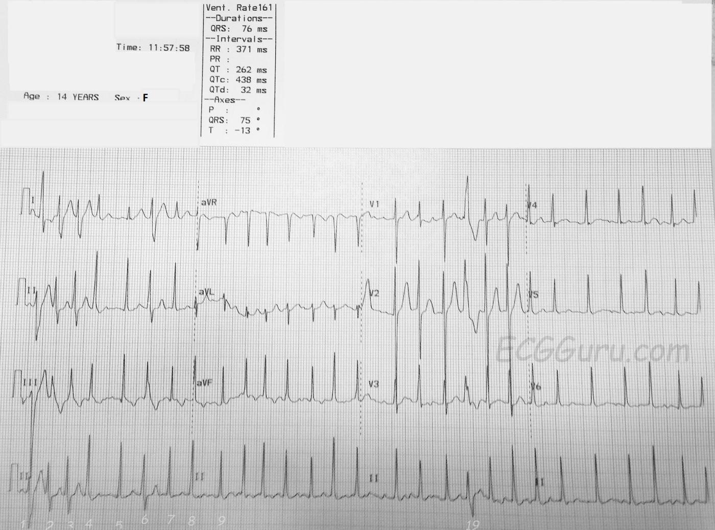 Atrial Fibrillation With Aberrant Conduction In Adolescent Patient Ecg Guru Instructor Resources